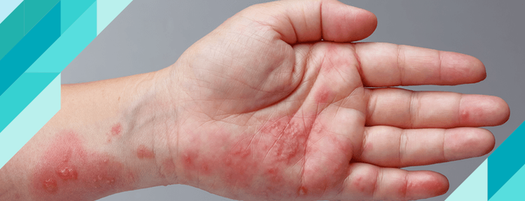 What is Shingles? What Causes Shingles?