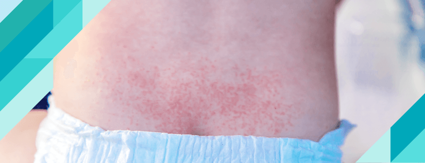 What Causes Diaper Rash? How Does Diaper Rash Go Away?