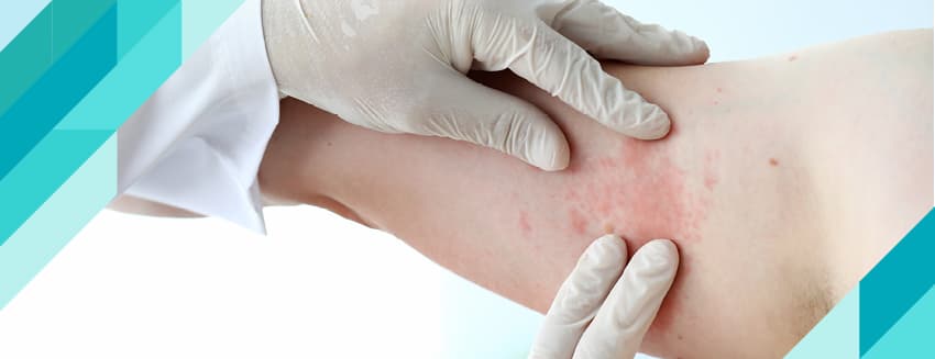 What is Skin (Dermal) Cancer? What are the Symptoms?