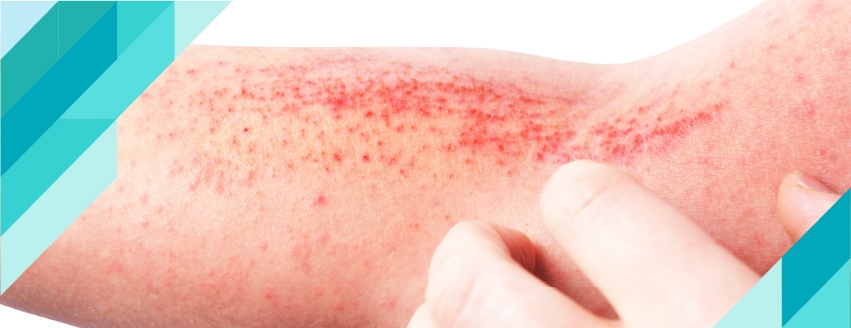 What is Contact Dermatitis? What are the Symptoms?