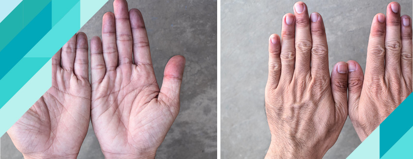 What is Cyanosis?
